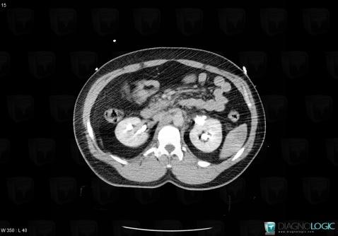 Radiology case : Urinoma (CT) - Diagnologic