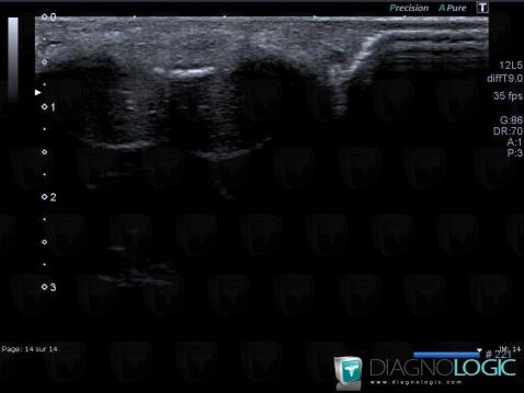 Radiology case : Peyronie's disease (US) - Diagnologic