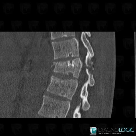 Radiology case : Vertebral fracture (CT ,MRI) - Diagnologic