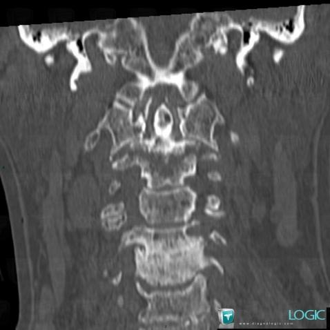 Radiology case : Dislocation (CT) - Diagnologic