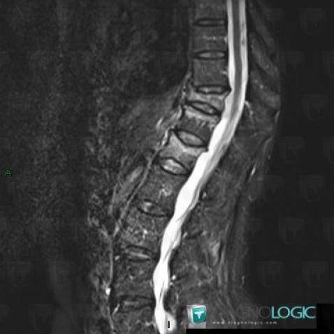 Radiology case : Vertebral fracture (MRI) - Diagnologic