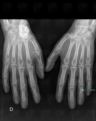 Radiology case : Scleroderma (CT ,US ,X rays) - Diagnologic